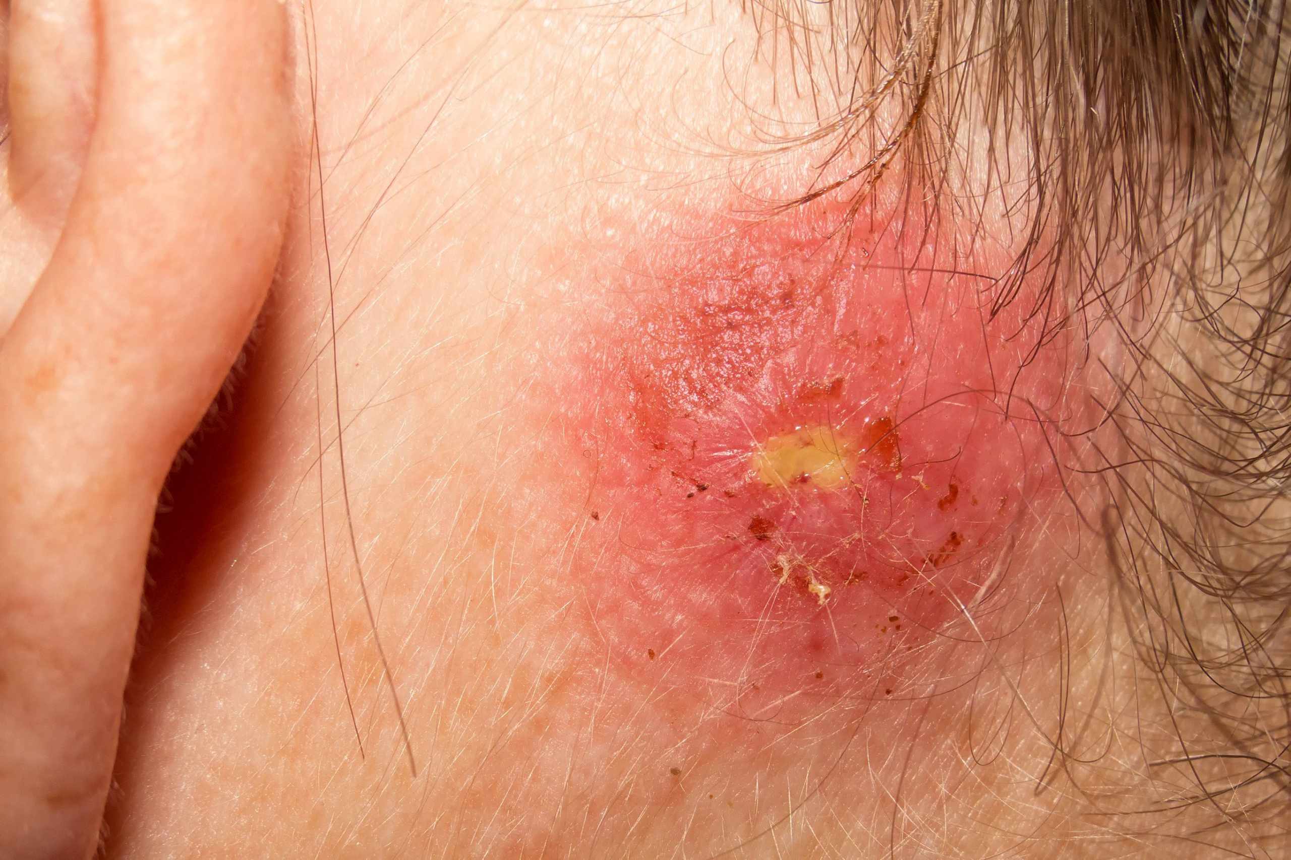 staph infection on skin: Causes and prevention in 2021